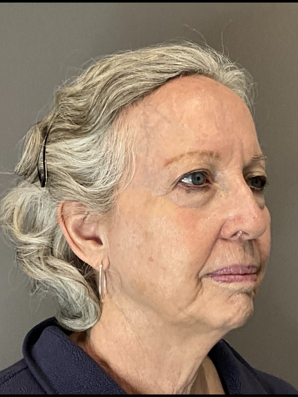 Dermal Fillers Fort Collins | Hyaluronic Acid | Harmony Skin