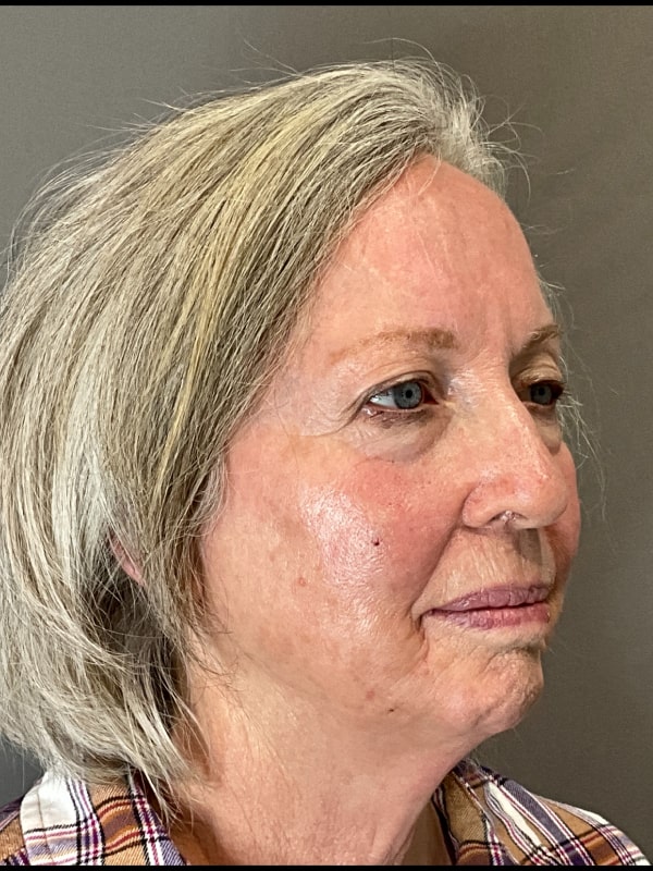 Dermal Fillers Fort Collins | Hyaluronic Acid | Harmony Skin