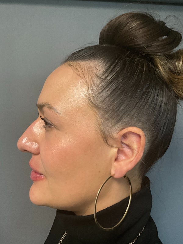 Dermal Fillers Fort Collins | Hyaluronic Acid | Harmony Skin