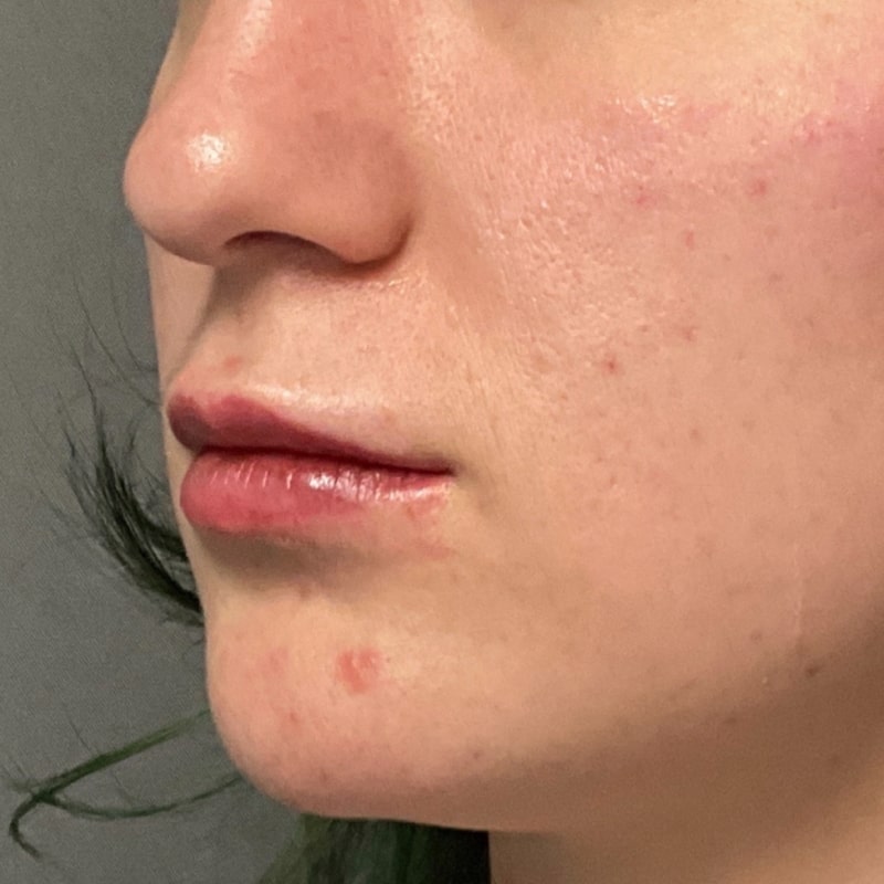 Dermal Fillers Fort Collins | Hyaluronic Acid | Harmony Skin