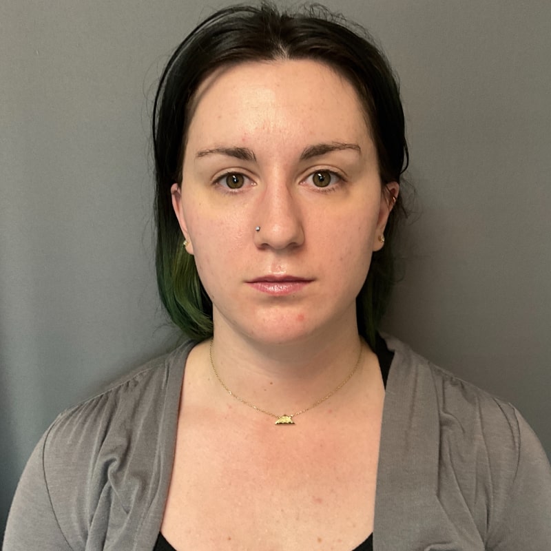 Dermal Fillers Fort Collins | Hyaluronic Acid | Harmony Skin