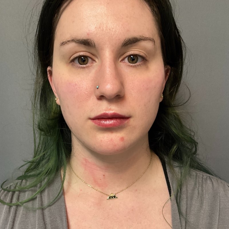 Dermal Fillers Fort Collins | Hyaluronic Acid | Harmony Skin