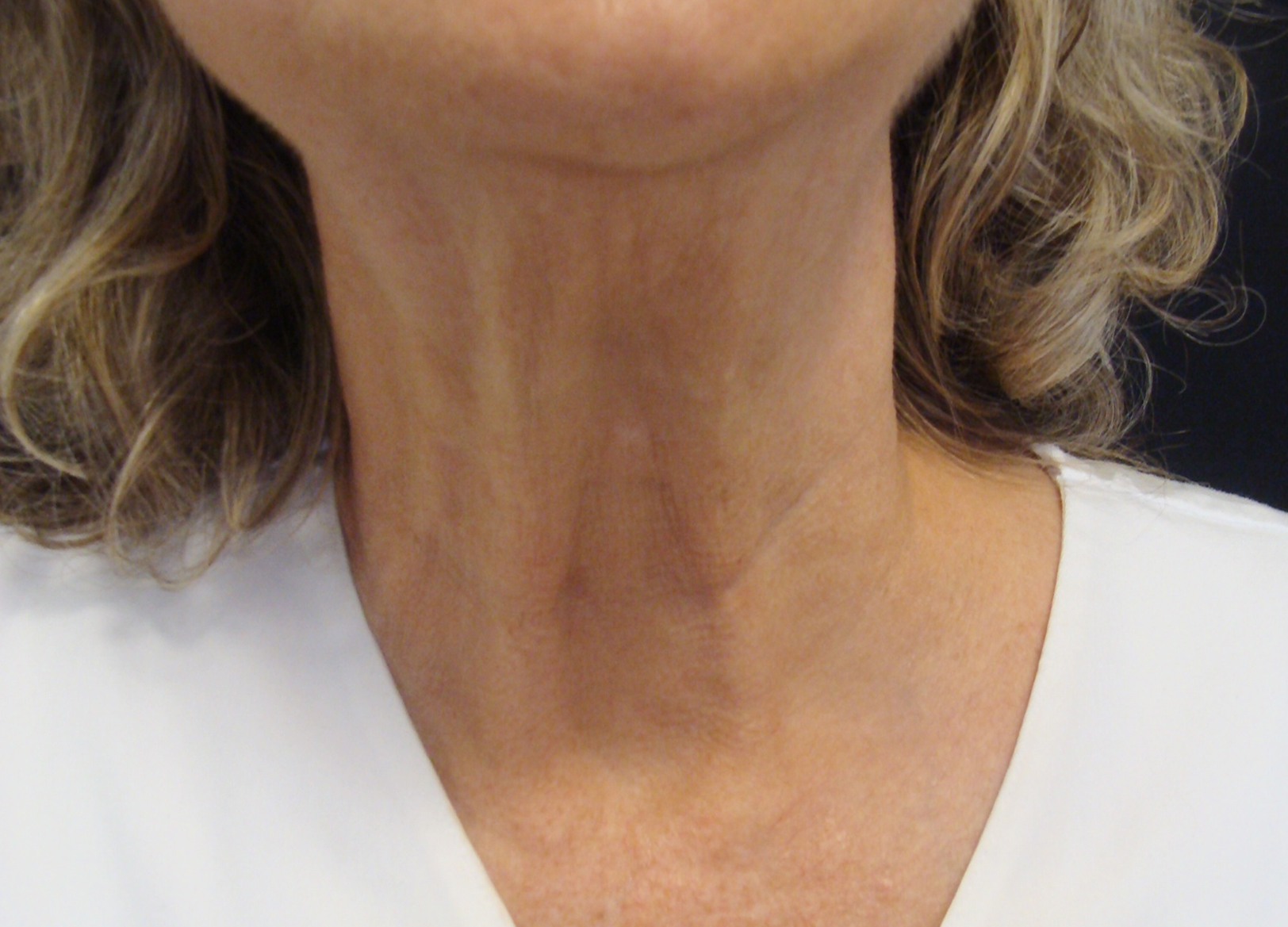 Exilis Ultra Before & After Patient 01 | Harmony Skin & Wellness