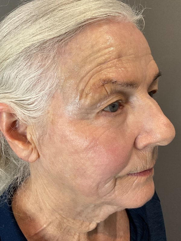 Matrix C02 Before & After Patient 01 | Harmony Skin & Wellness