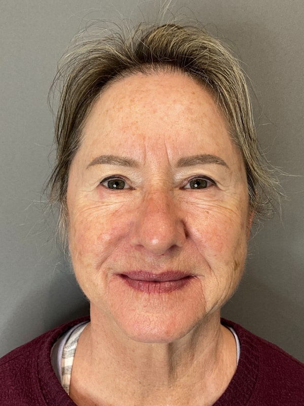 Laser Skin Resurfacing Fort Collins | Harmony Skin & Wellness Clinic