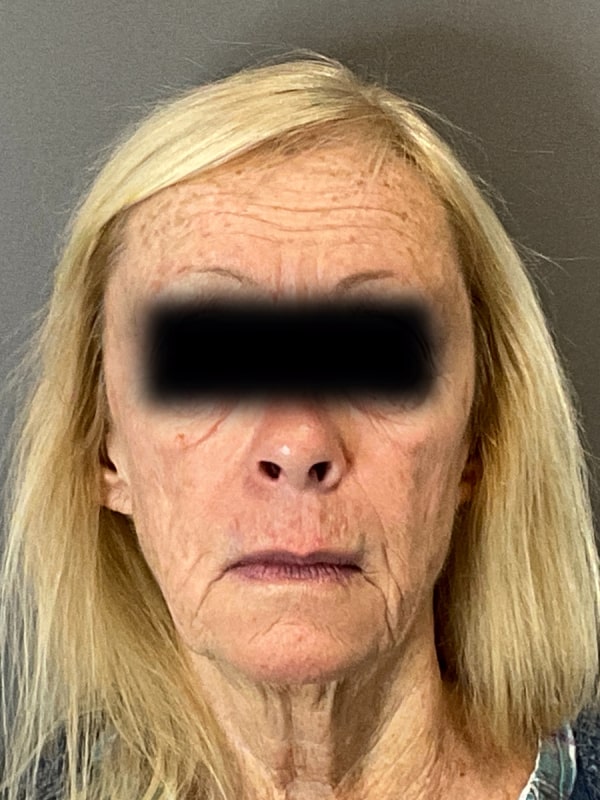 Laser Skin Resurfacing Fort Collins | Harmony Skin & Wellness Clinic