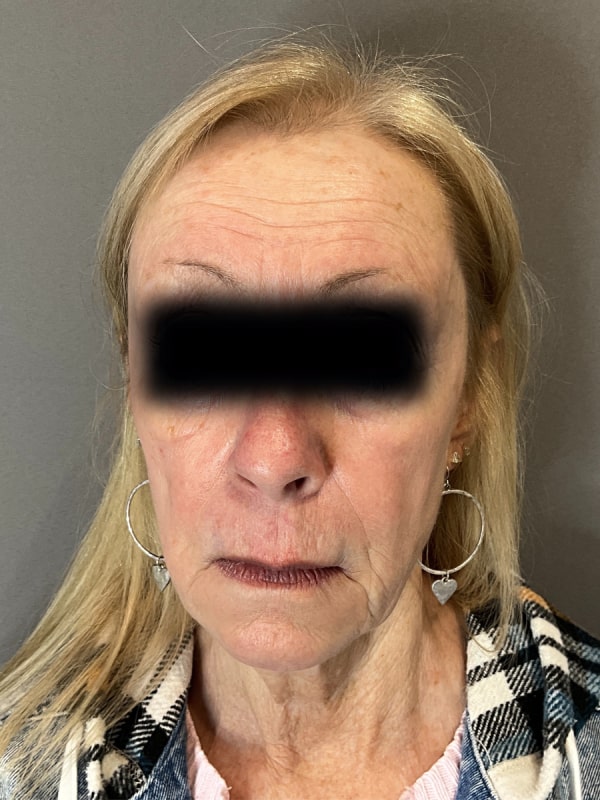 Laser Skin Resurfacing Fort Collins | Harmony Skin & Wellness Clinic