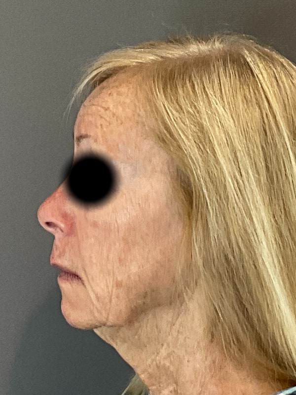 Laser Skin Resurfacing Fort Collins | Harmony Skin & Wellness Clinic