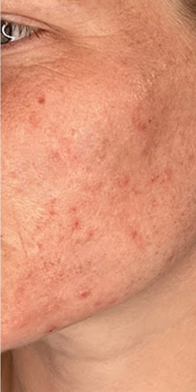 Before & After CryoSkin Fort Collins | Harmony Skin & Wellness